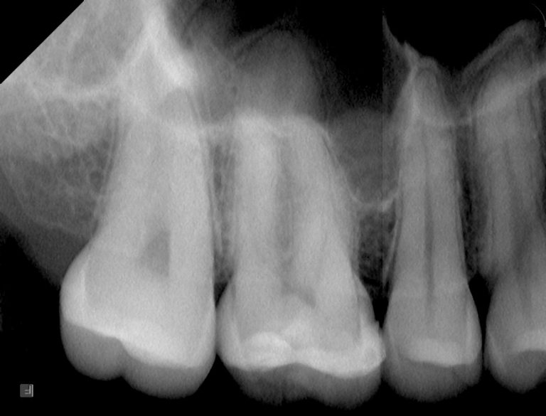 Ortopan | 2D slikanje zob | RTG studio Sever | Maribor